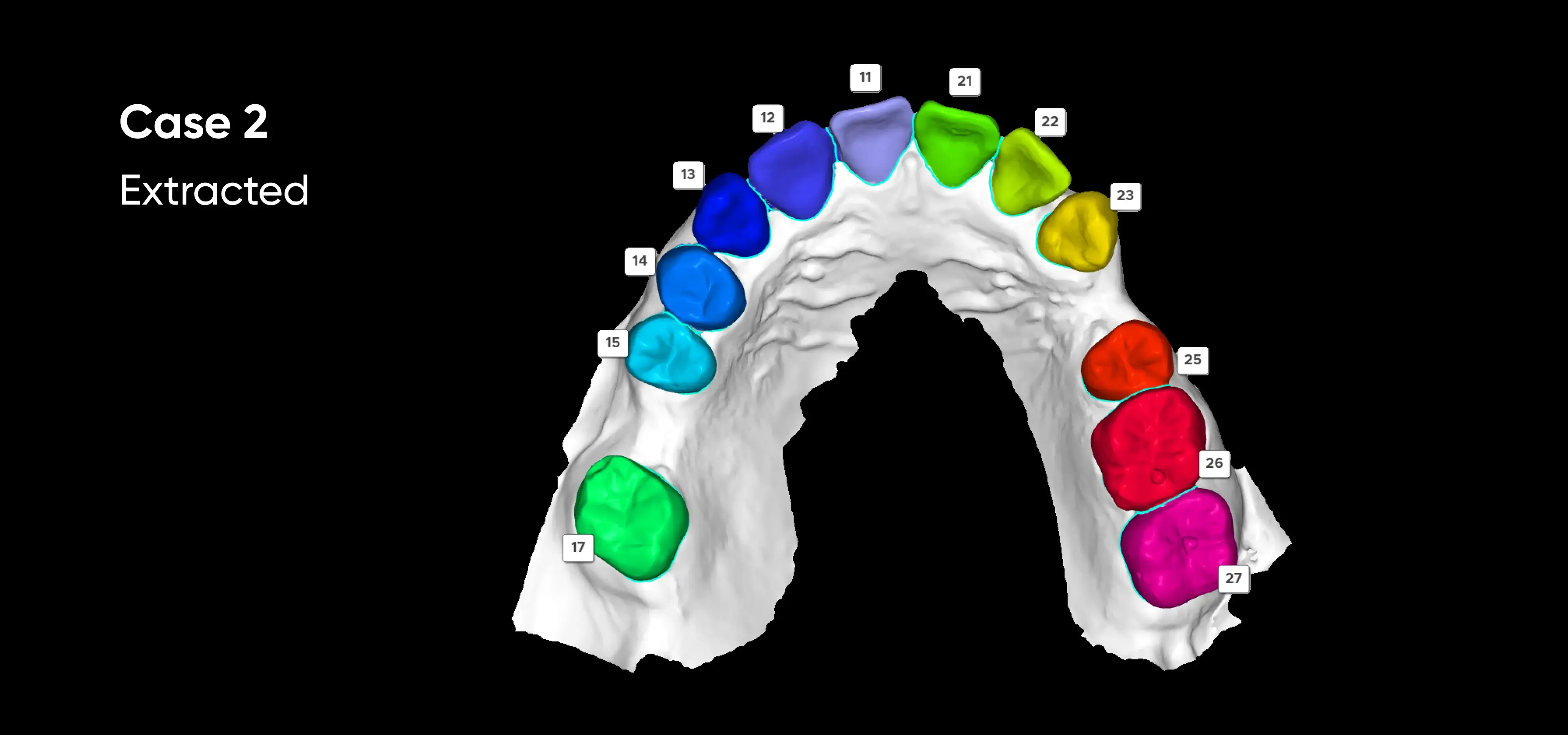 Case 2 upper teeth scan with every tooth in different color and number ...