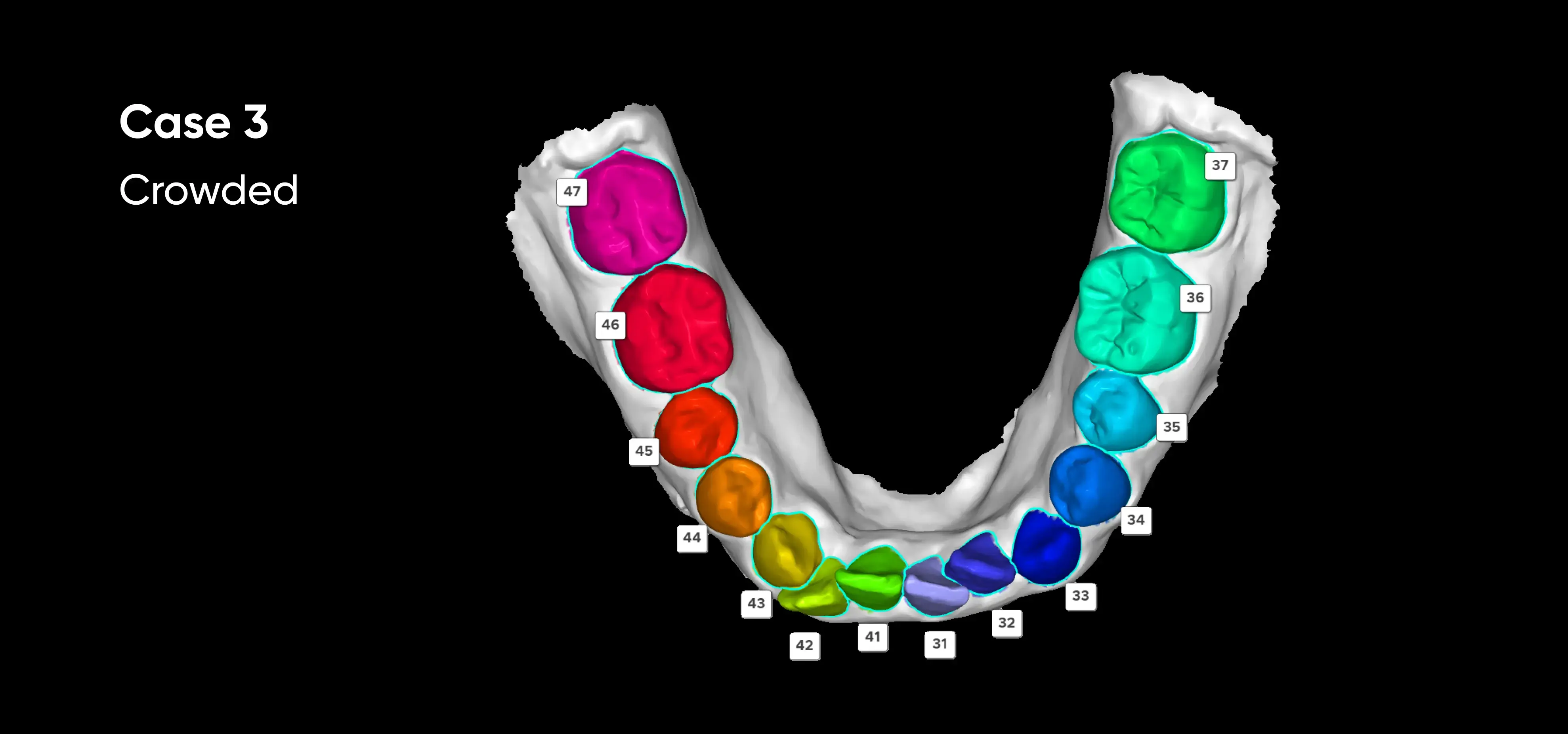 Case 3 lower teeth scan with every tooth in different color and number ...