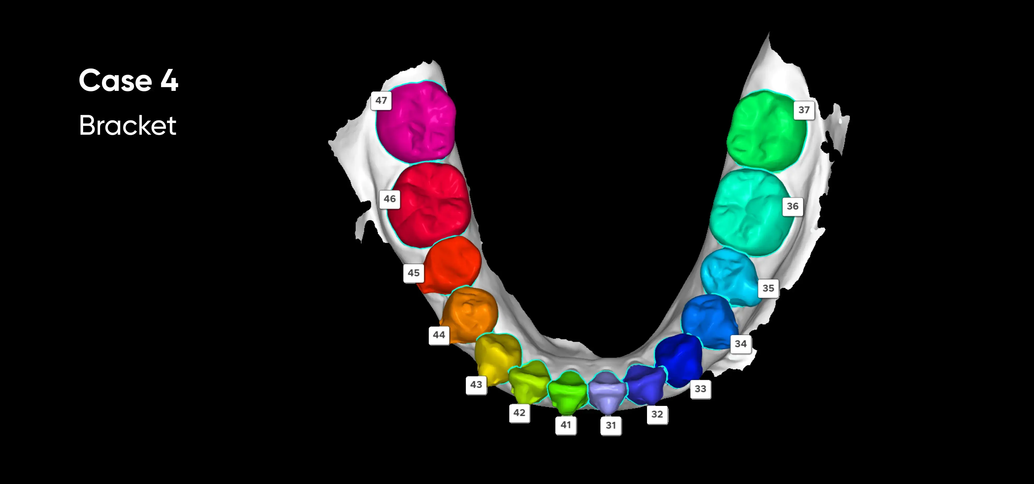 Case 4 lower teeth scan with bracket and every tooth in different color and number
